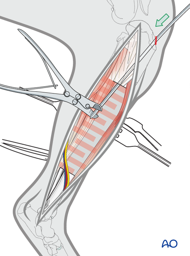 Plate and rod for Complex segmental