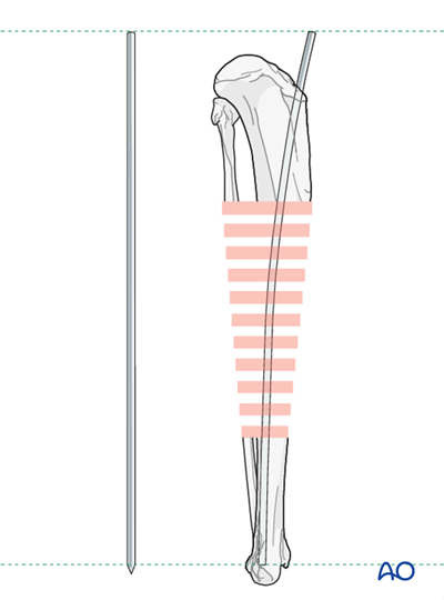 Plate and rod for Several reducible wedges in the tibial diaphysis
