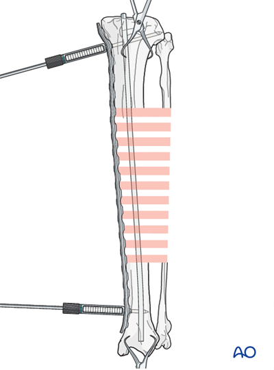 Plate and rod for Complex with nonreducible wedges in the tibial diaphysis