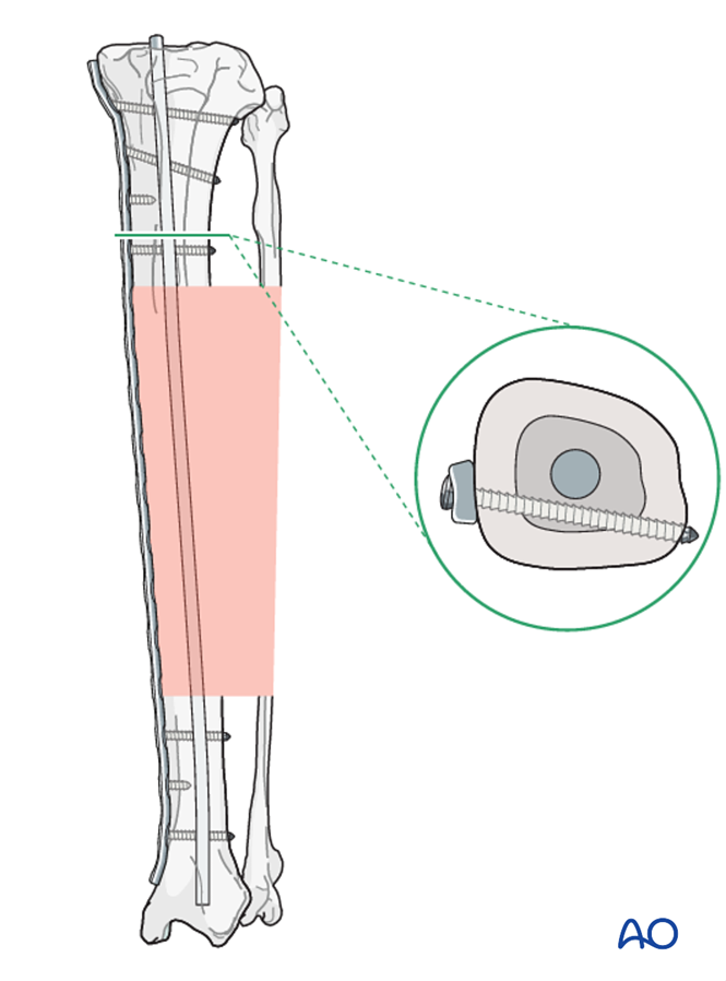 Plate and rod for Complex with nonreducible wedges in the tibial diaphysis