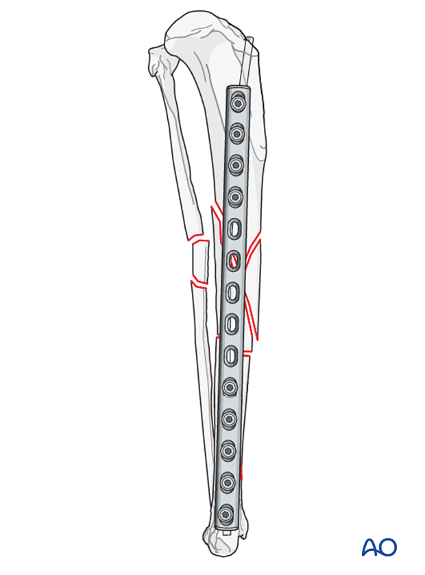 Plate and rod for Complex with reducible wedges in the tibial diaphysis