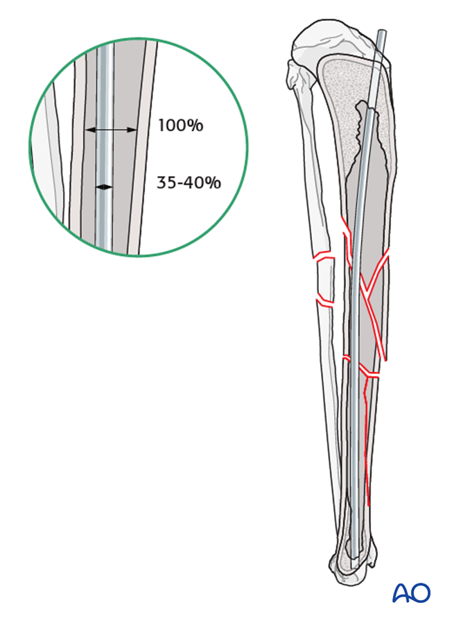 Plate and rod for Complex with reducible wedges in the tibial diaphysis