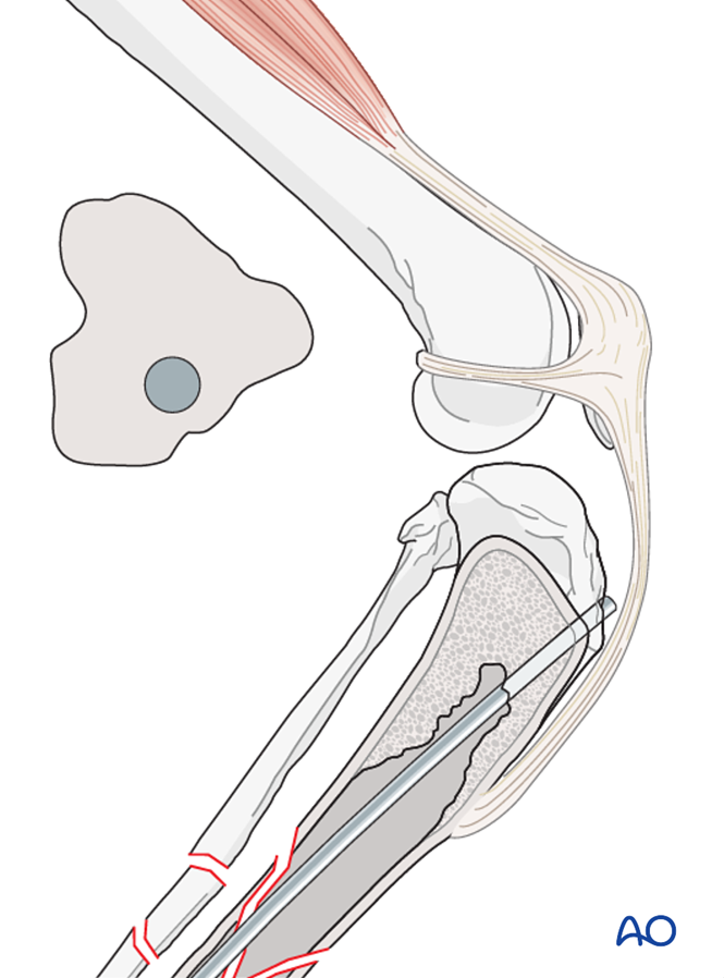 Plate and rod for Complex with reducible wedges in the tibial diaphysis