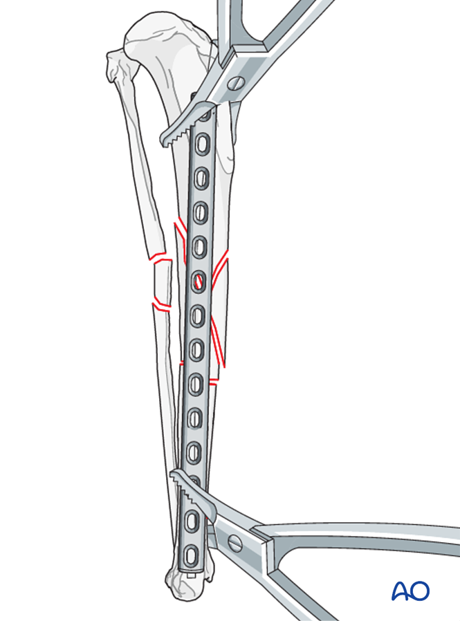 Plate and rod for Complex with reducible wedges in the tibial diaphysis