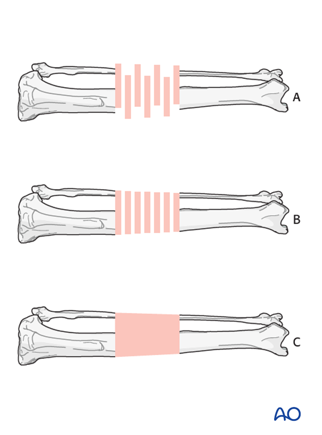Plate and rod for Complex segmental