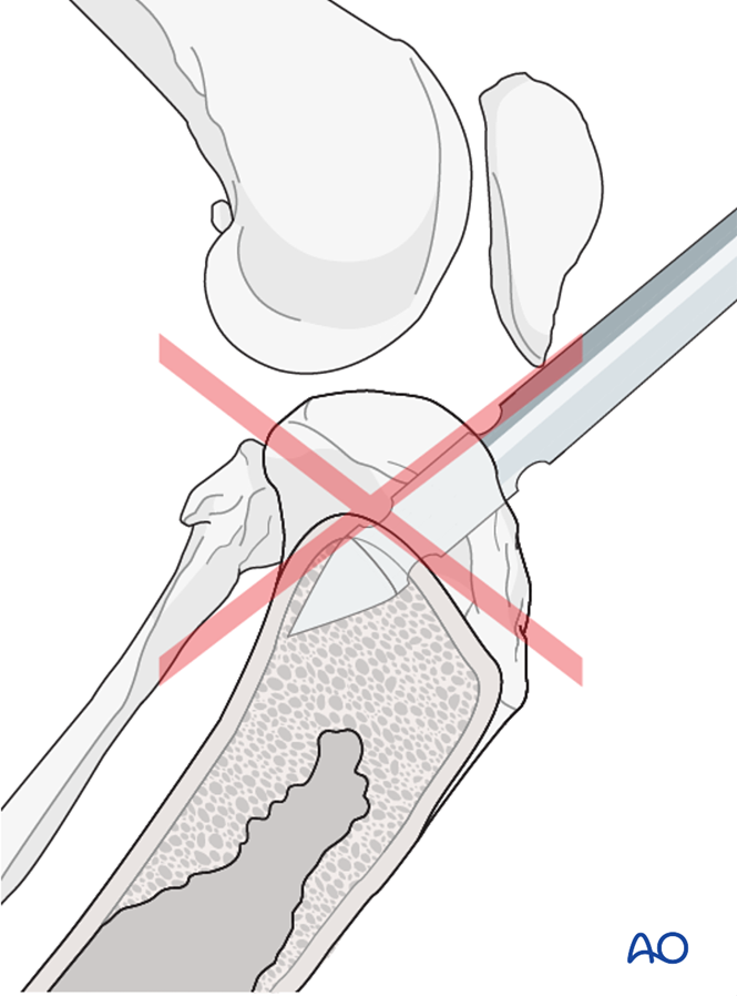Interlocking nail for Nonreducible wedges in the tibial diaphysis