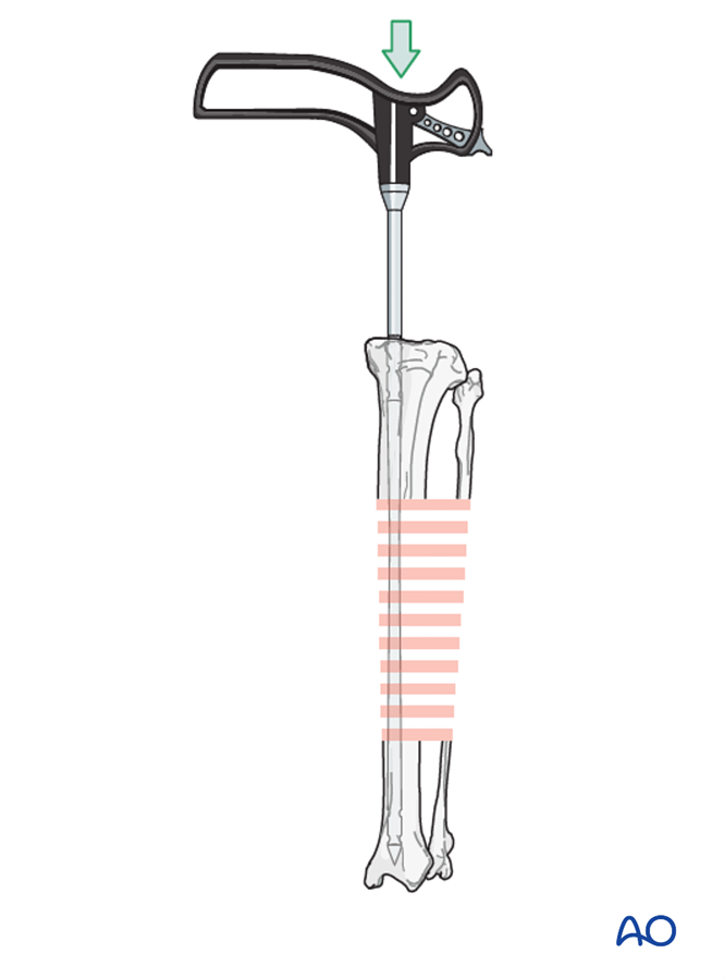 Interlocking nail for Nonreducible wedges in the tibial diaphysis