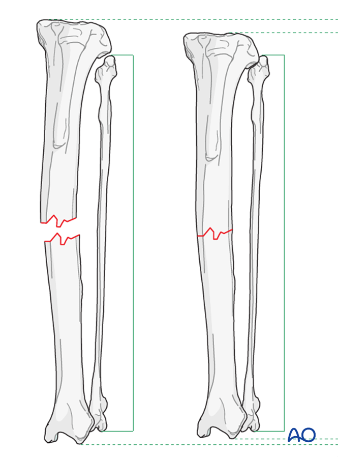 Bridging plate for Incomplete fracture of the tibia or complete ...