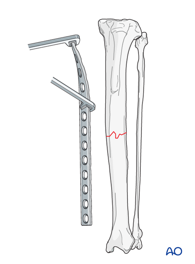 Bridging plate for Incomplete fracture of the tibia or complete ...