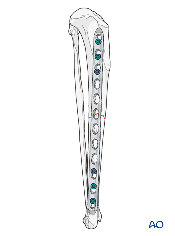 Bridging plate for Incomplete fracture of the tibia or complete ...