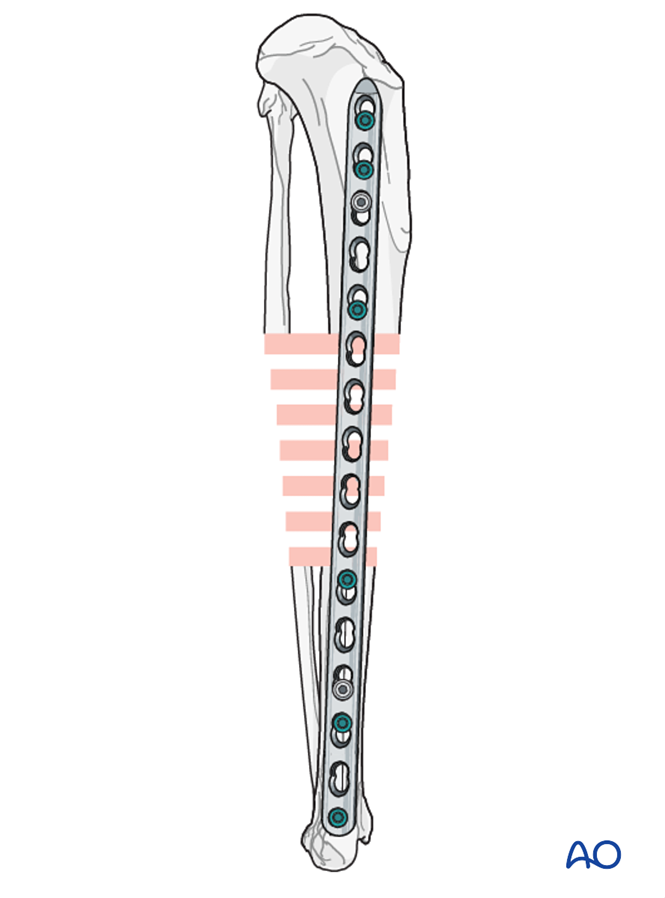 Bridging plate for One large reducible wedge in the tibial diaphysis