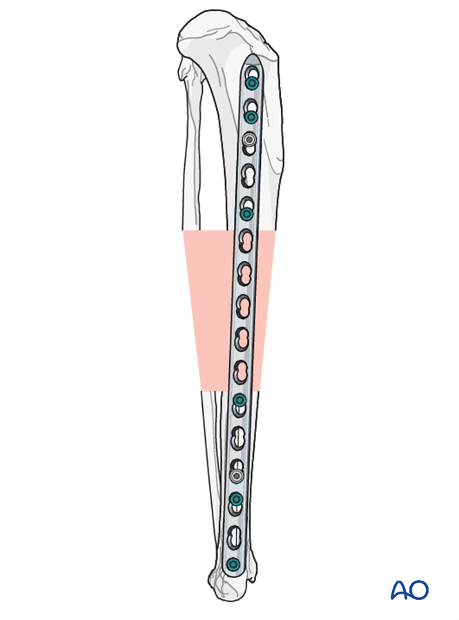 Bridging plate for One large reducible wedge in the tibial diaphysis