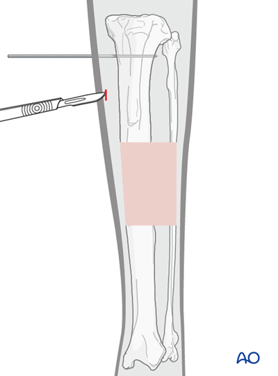 External fixator for Complex with nonreducible wedges in the tibial ...