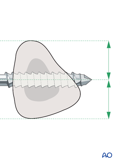 External fixator for Incomplete fracture of the tibia or complete ...