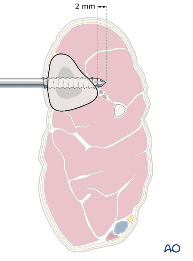 External fixator for Complex with nonreducible wedges in the tibial ...