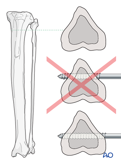 External fixator for One large reducible wedge in the tibial diaphysis