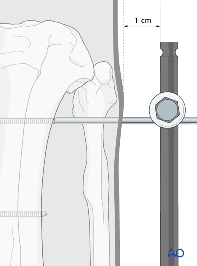 External fixator for Incomplete fracture of the tibia or complete ...