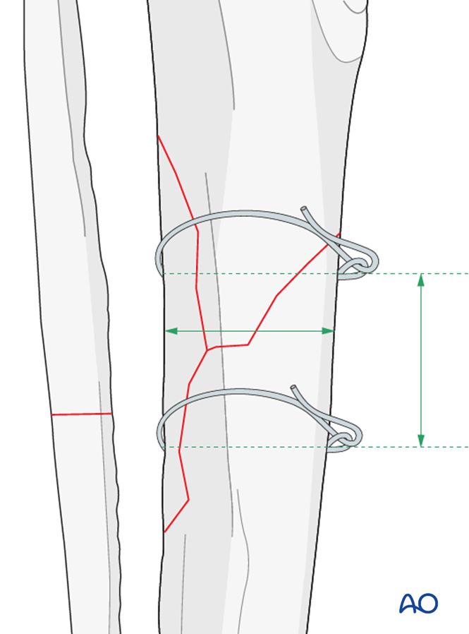 Cerclage wires technique