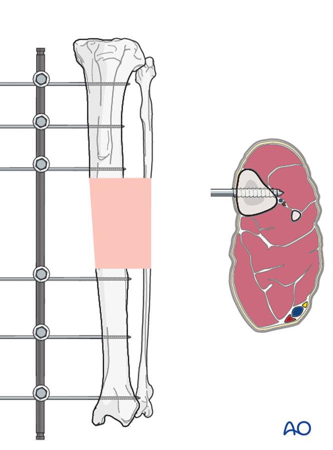 General considerations on external skeletal fixators