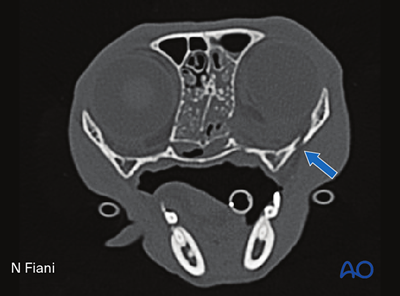 Midface - Frontonasal fracture