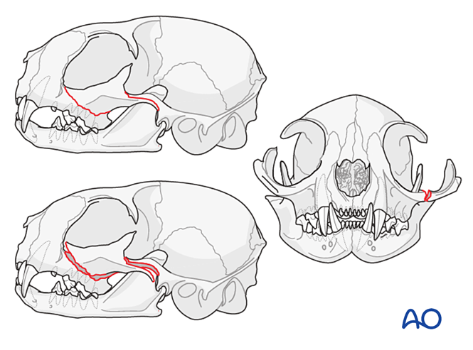 Midface - Zygomatic arch fracture