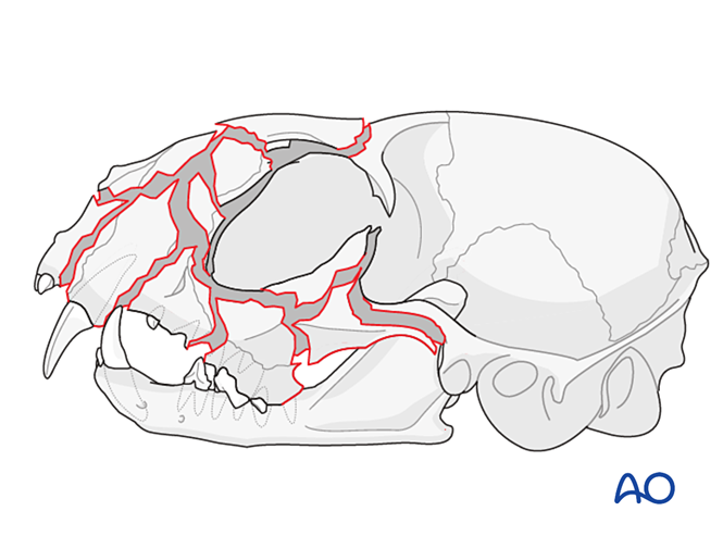 Midface - Panfacial fracture