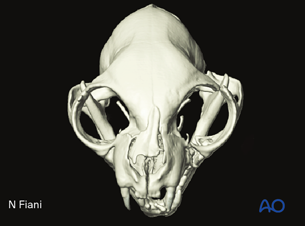 Midface - Panfacial fracture
