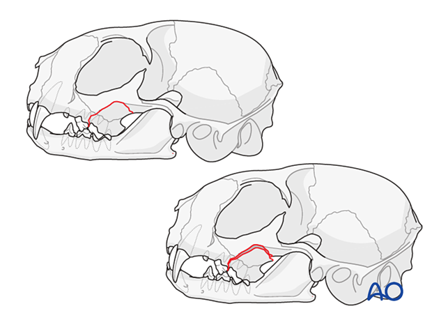 Midface - Caudal maxillary fracture