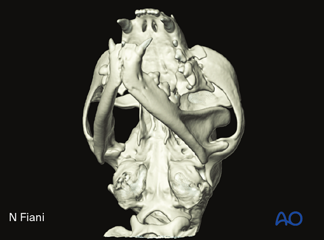 Midface - Caudal maxillary fracture