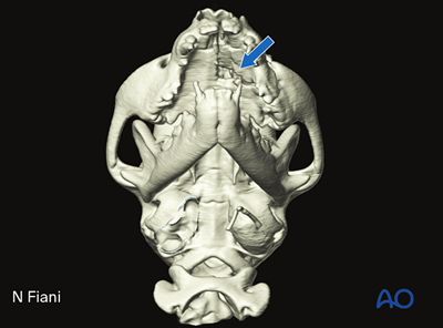 Midface - Palatal fracture