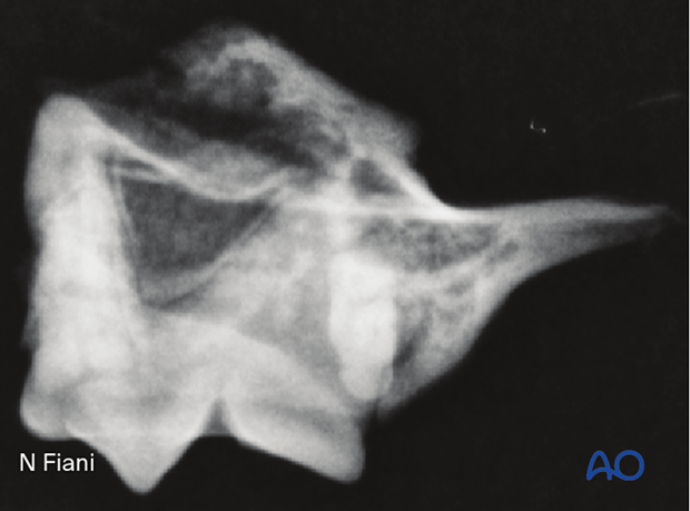 Salvage procedures for Midface - Frontonasal fracture