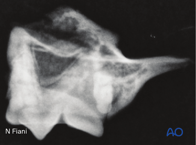 Salvage procedures for Midface - Frontonasal fracture