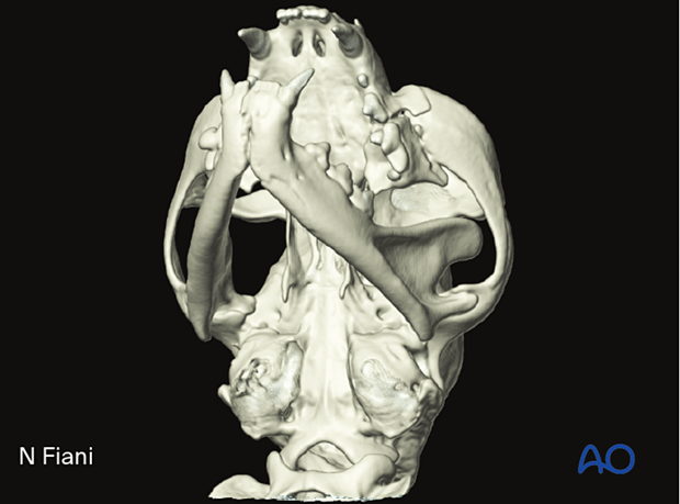 Salvage procedures for Midface - Caudal maxillary fracture