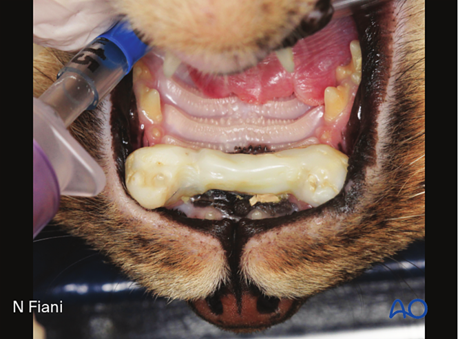 Palatal intraoral splint fixation for Midface - Palatal fracture
