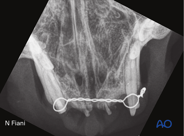 Palatal intraoral splint fixation for Midface - Palatal fracture