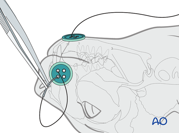 Nonsurgical fracture management for Midface - Rostral fracture