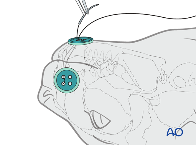 Nonsurgical fracture management for Midface - Zygomatic arch fracture