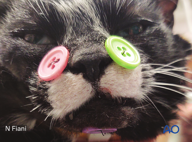 Nonsurgical fracture management for Midface - Palatal fracture