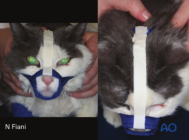 Nonsurgical fracture management for Midface - Palatal fracture
