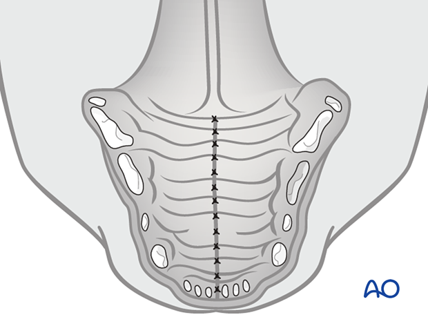 Soft-tissue debridement/management for Midface - Palatal fracture