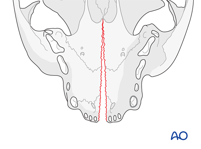 Palatal intraoral splint fixation for Midface - Palatal fracture