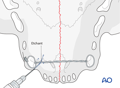 Palatal intraoral splint fixation for Midface - Palatal fracture