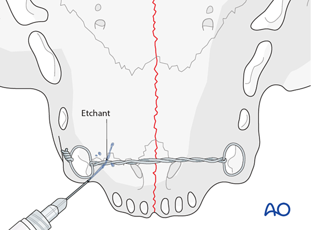 Palatal intraoral splint fixation for Midface - Palatal fracture