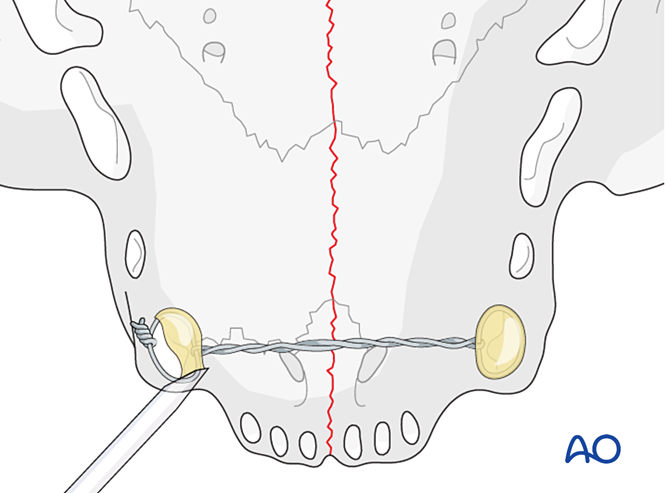 Palatal intraoral splint fixation for Midface - Palatal fracture