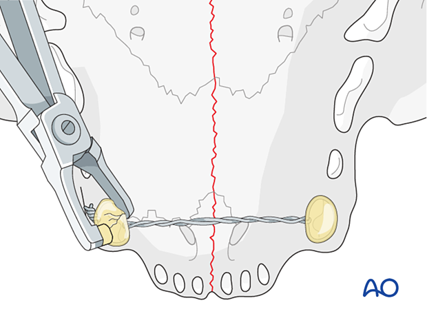 Palatal intraoral splint fixation for Midface - Palatal fracture