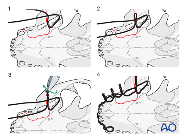 Intraoral splint fixation for Midface - Caudal maxillary fracture