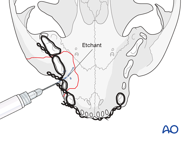 Intraoral splint fixation for Midface - Caudal maxillary fracture