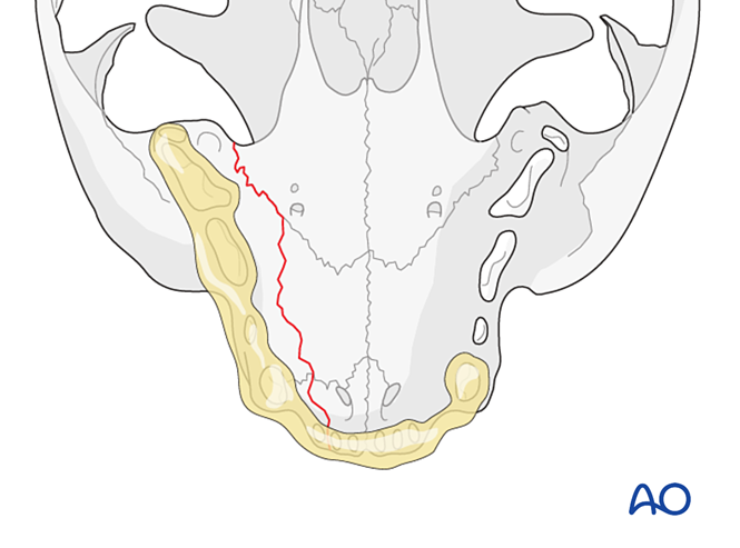 Intraoral splint fixation for Midface - Caudal maxillary fracture