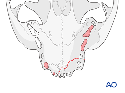 Rostral intraoral splint fixation for Midface - Rostral fracture