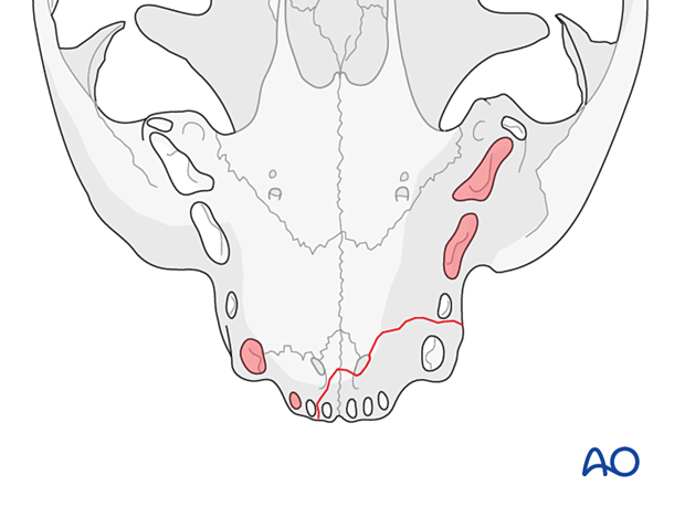 Rostral intraoral splint fixation for Midface - Panfacial fracture